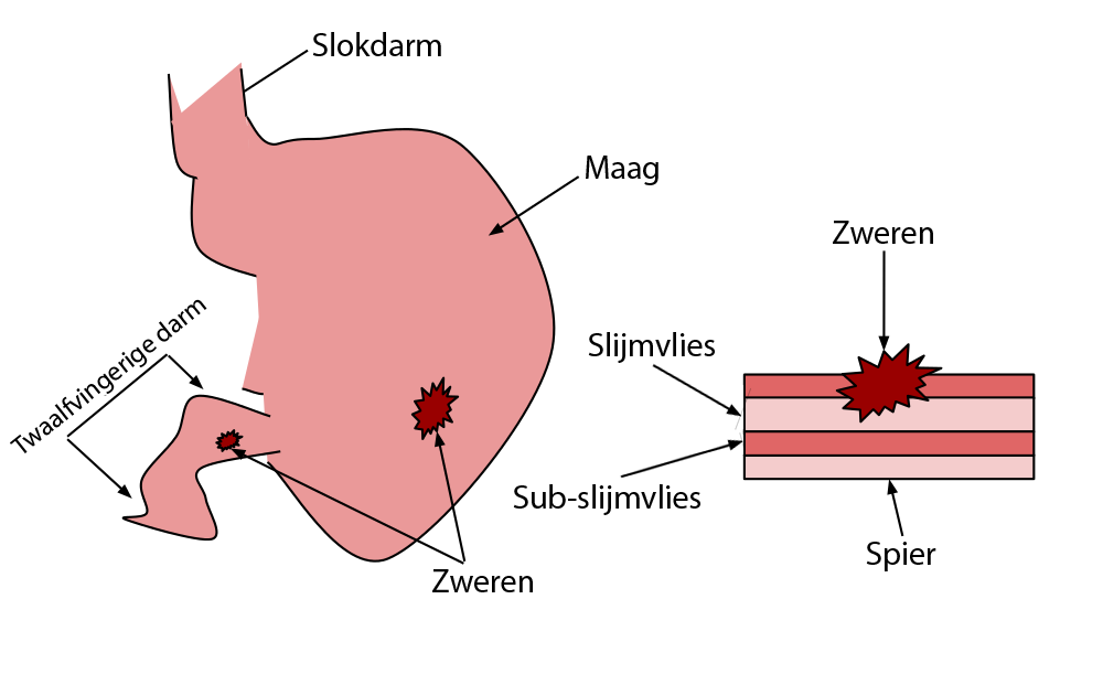 Maagzweer - Acupunctuur en Gezondheidscentrum Chen
